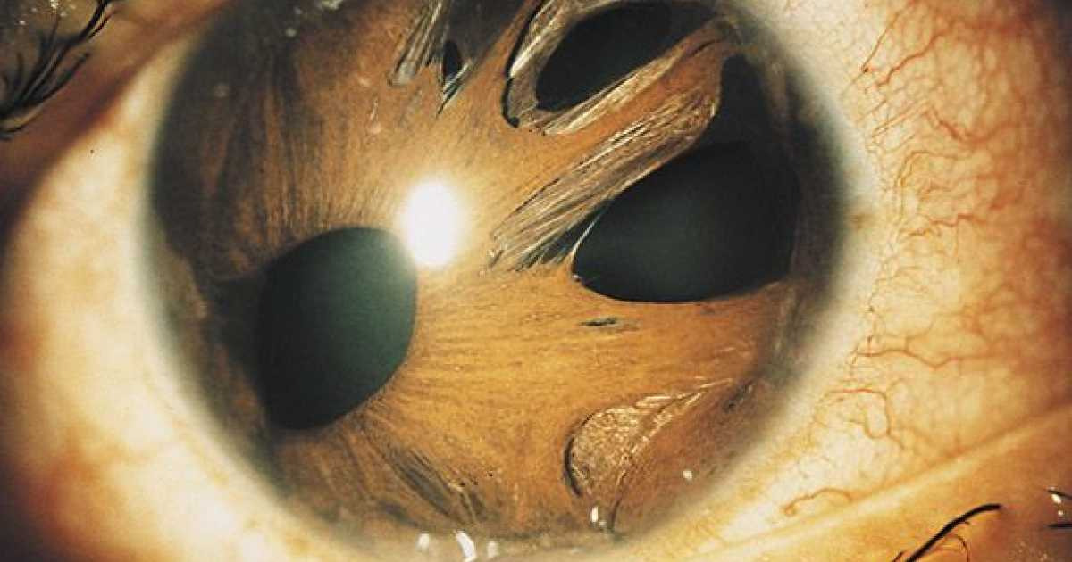 ICE syndrome, 챈들러 증후군(Chandler syndrome)과 진행성 홍채위축(Progressive ...