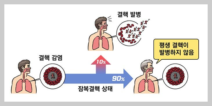 결핵 증상 원인 잠복 결핵 무료 치료 격리 기간 합병증 예방