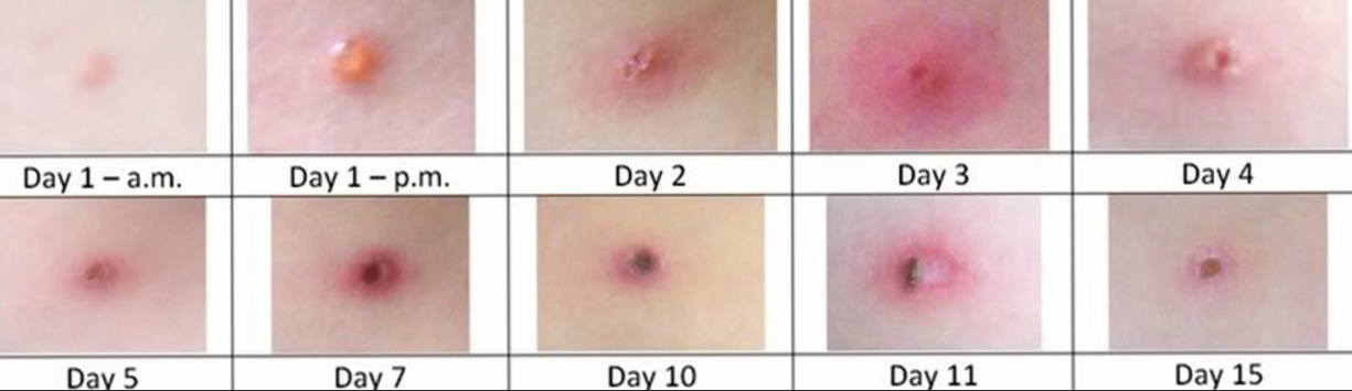 수두 초기증상과 전염 격리기간 얼마나 1분 정리