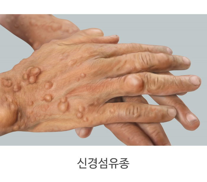 신경섬유종 원인 증상 치료 관리 등 총 정리