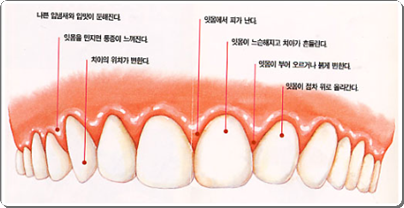 치은염 및 치주질환 원인 증상 치료방법 예방방법