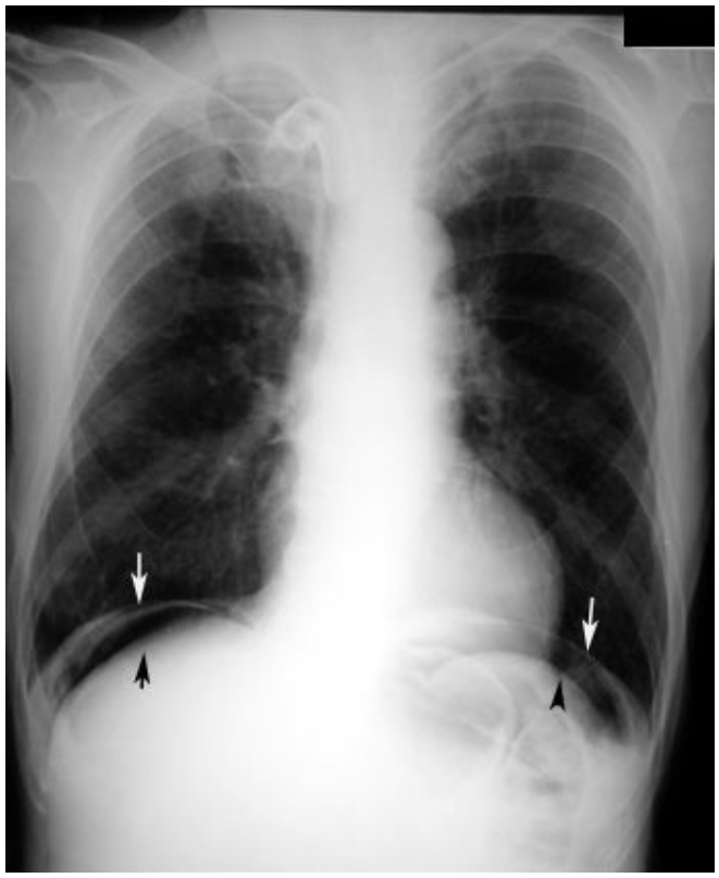 흉부 x ray의 해석 - 체계적인 접근법(chest PA)