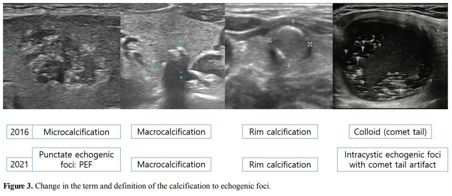 갑상선 결절 (2021 K-TIRADS)