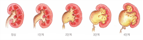 태아 수신증 신생아 수신증 원인 및 치료방법 추천병원