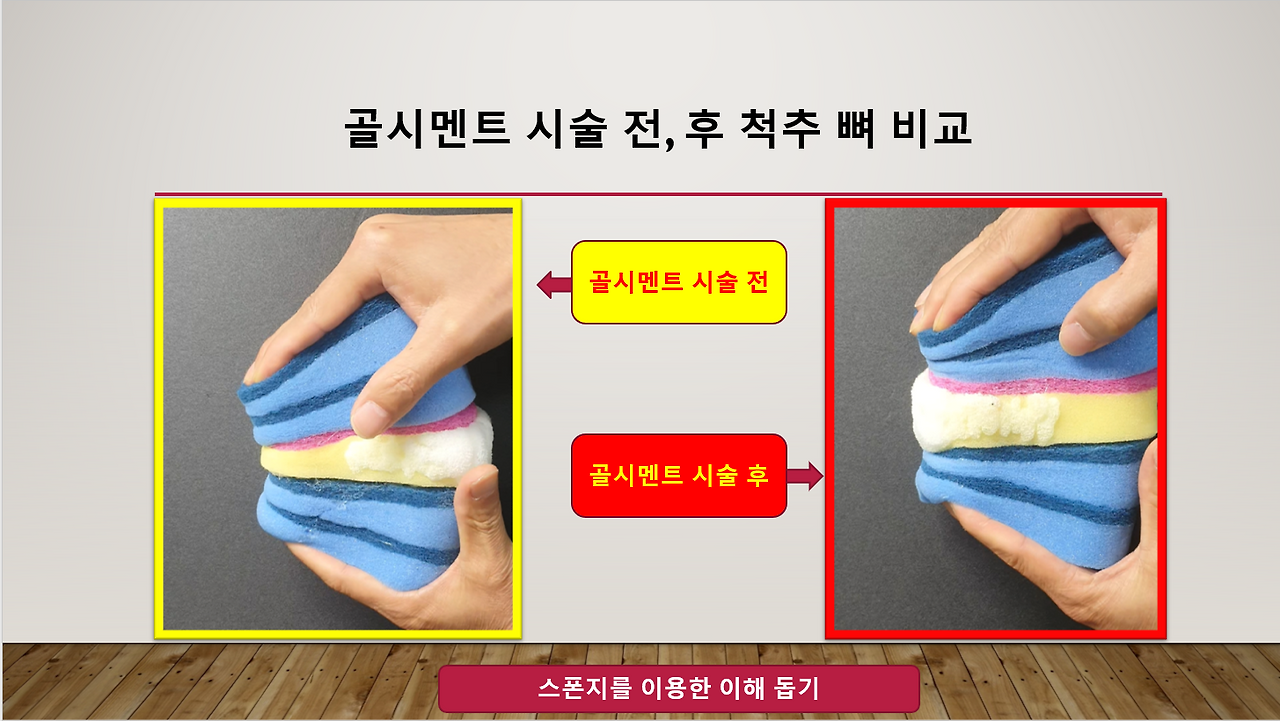 척추압박골절 부위 골시멘트 시술 전후 비교