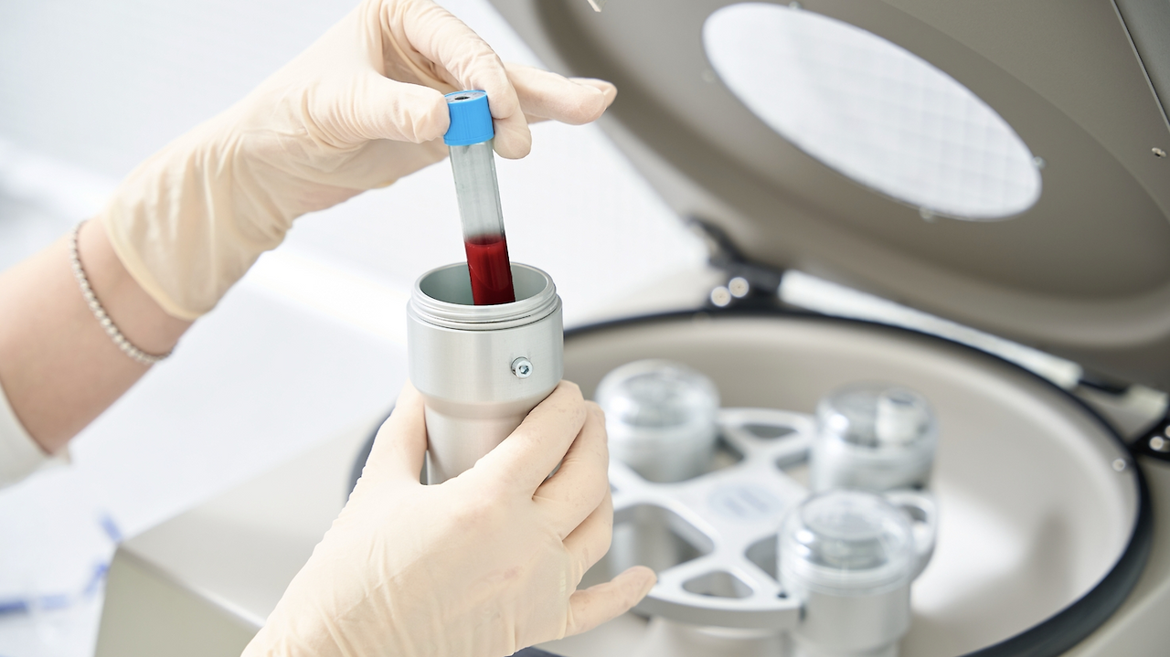 혈소판platelet 정상 수치 완벽 가이드 정상 고혈소판증 저혈소판증의 증상과 관리법