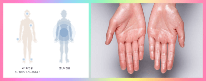다한증 원인증상 치료 예방법 수술비용 후기 및 치료 잘하는 병원 보험적용여부겨드랑이 손 발안면 다한증 치료