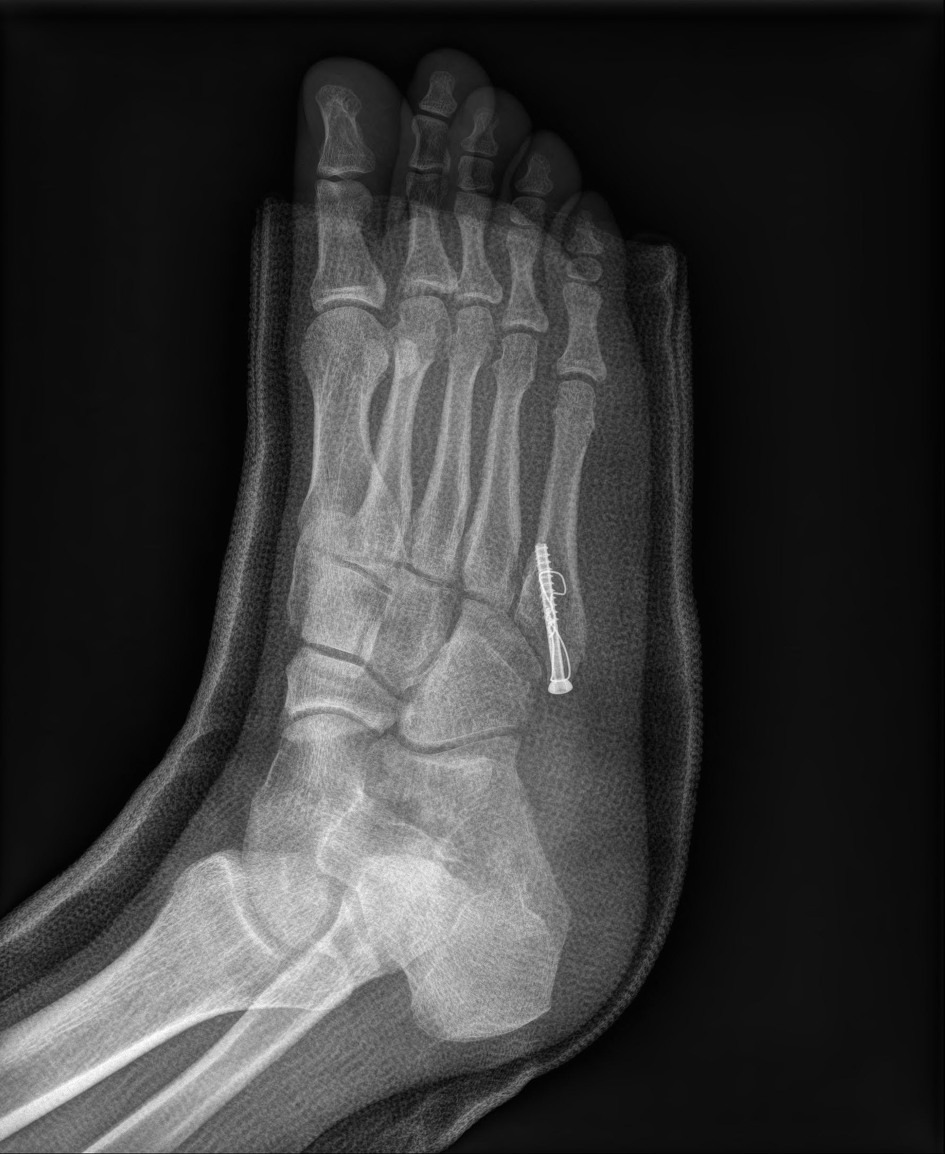 제5중족골 기저부 골절 Jones Fracture 존스 골절