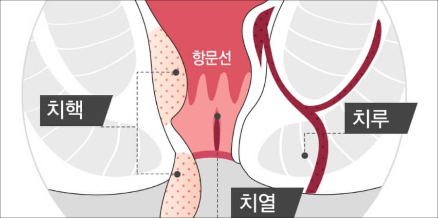 치핵 치질 증상 및 예방법 — 생활이슈