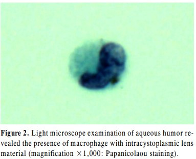수정체 과민증, 수정체관련 포도막염, phacoanaphylactic uveitis, phacoanaphylaxis.