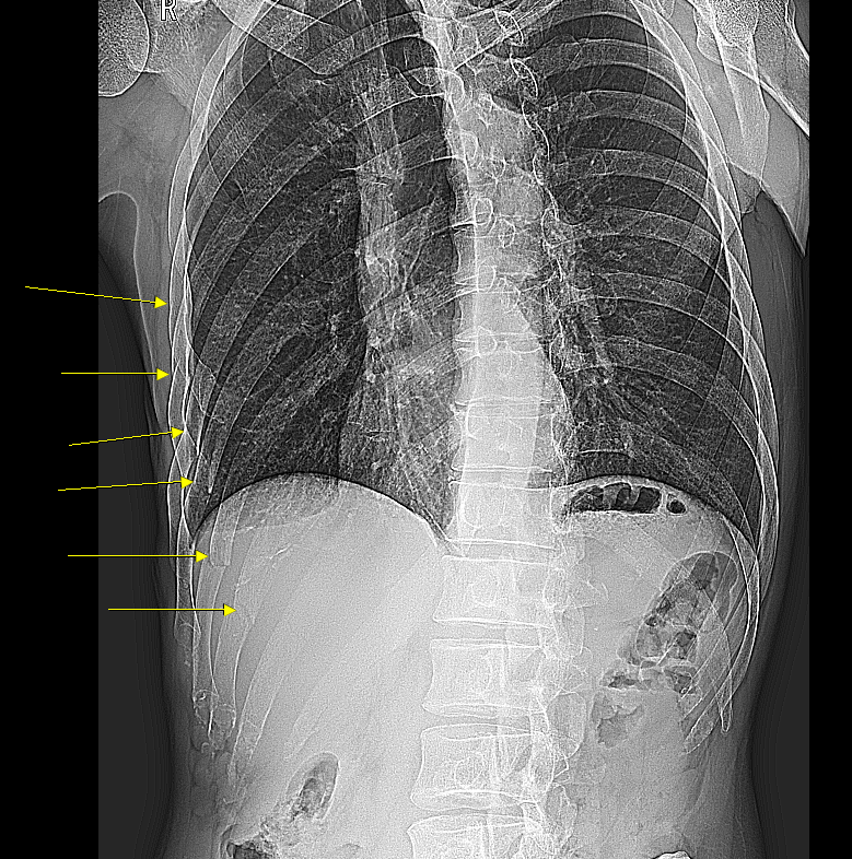 응급실 증례 Multiple Rib Fracture 다발성 갈비뼈 골절