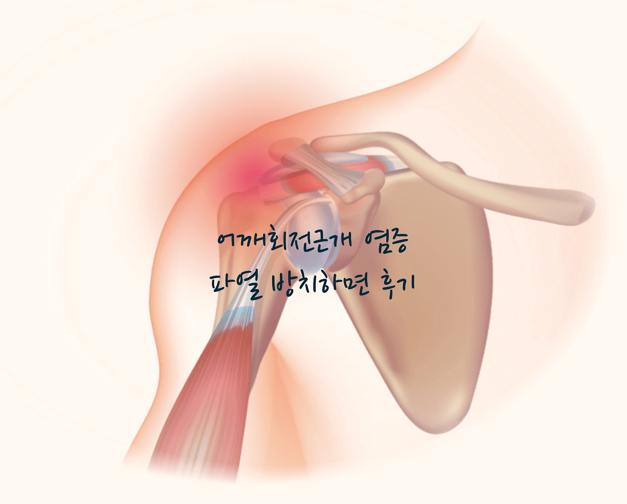 어깨회전근개 염증 파열 방치하면 후기