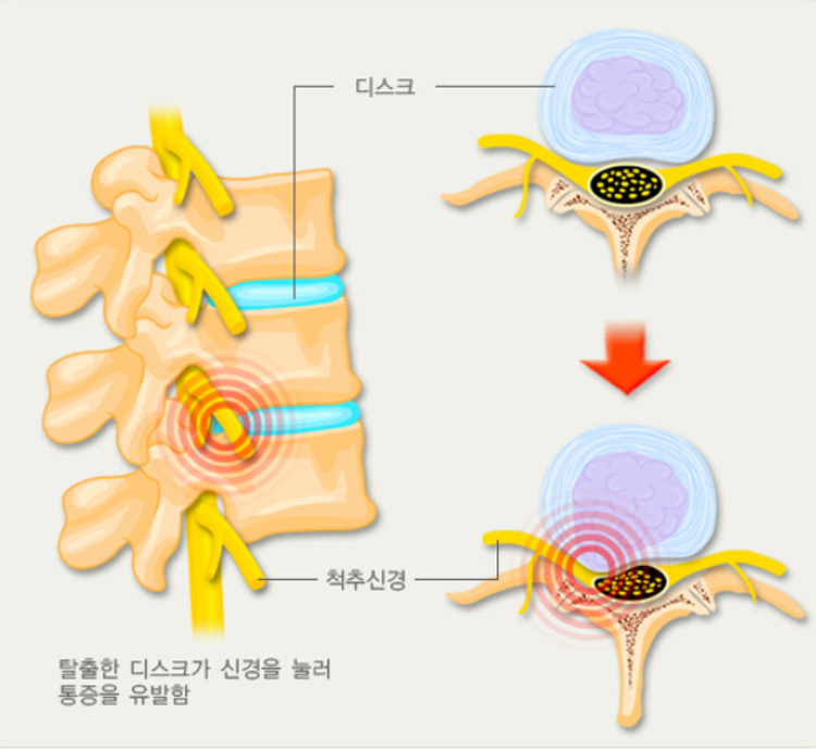 허리디스크 터지면 좌골신경통 증상 알아보기
