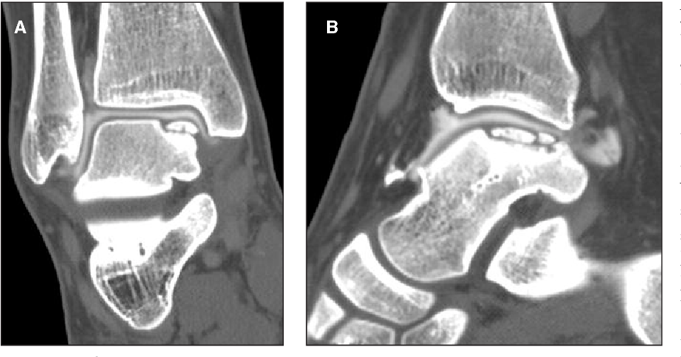 족관절 슬관절의 박리성 골연골염 Ankle And Knee Ocd Osteochondral Dissecans