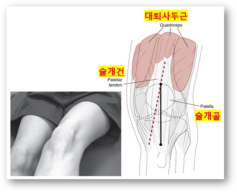 슬개골 골절 재활운동은 어떻게