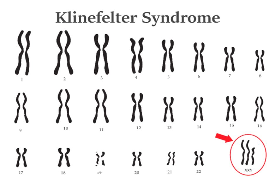클라인펠터 증후군kleinefelter Syndrome의 원인 증상 치료와 연구