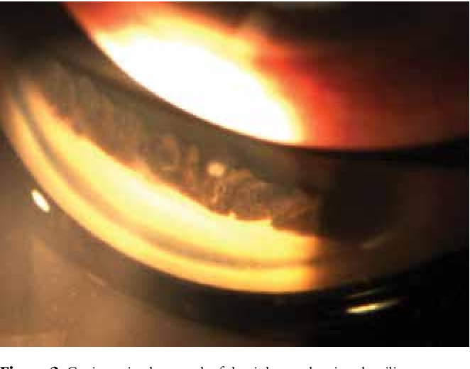 Diode Laser TransScleral CPC, 동공경유 광응고술, 눈속경유섬모체 광응고술