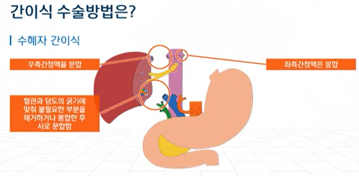 Ebs 간 이식 명의 주동진 교수 간경화 증상 간이식 방법 서울인포스트