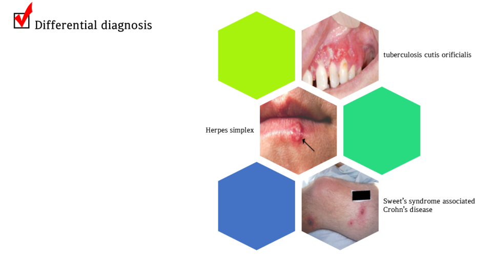 전주 이진복한의원 베체트병