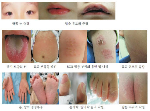 가와사키병 증상 치료 원인 후유증 전염 어린이 가와사키병 급성 열성 혈관염