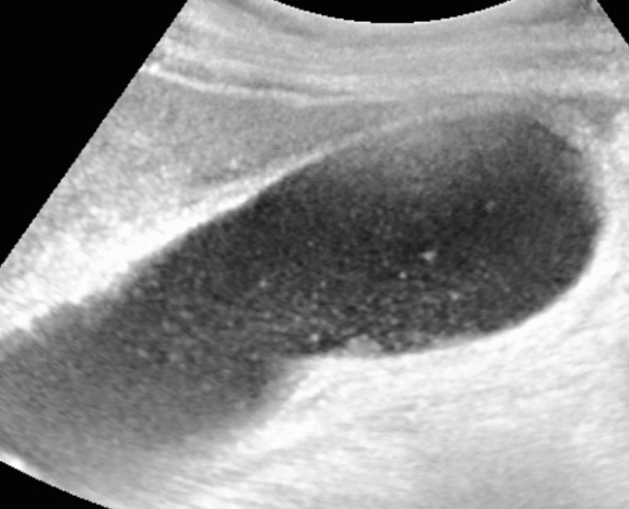 담낭 질환 (gallbladder disease) - adenomyomatosis & sludge :: ultrasound study