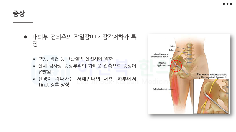 전주 이진복한의원 외측대퇴경피신경 포착증후군