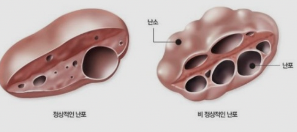 나의 난임 이야기2 다낭성 난소 증후군이란 과배란 유도와 난포주사