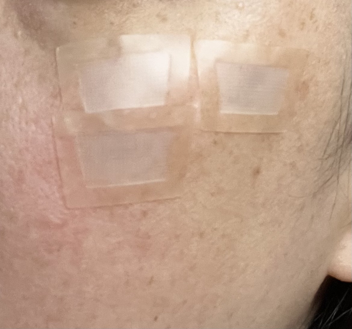 소소한 행복찾기 메디테라피 비타 리얼 샷 클리어 패치 리얼 후기