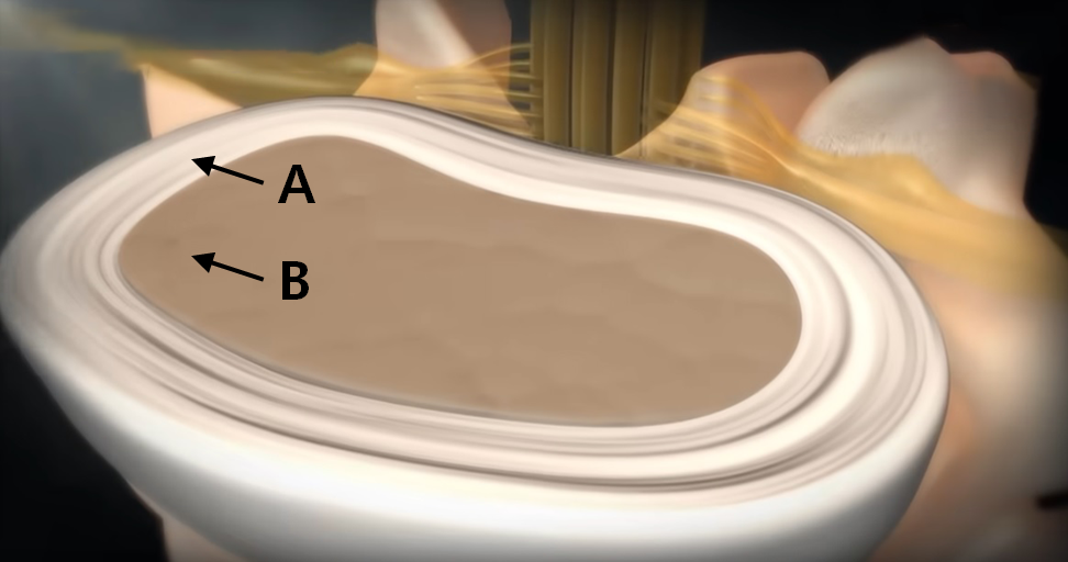 About disc herniation