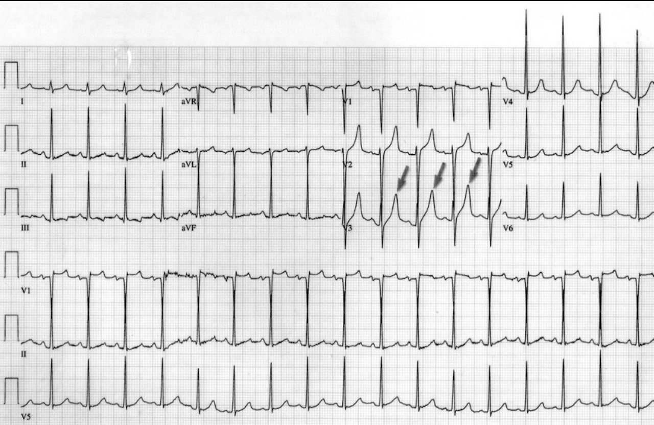 Hyperkalemia 고칼륨혈증 응급상황