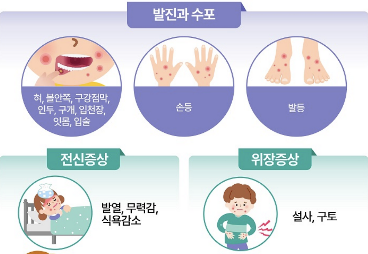 수족구 증상 전염 잠복기