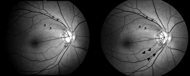 국소 망막신경섬유층 결손 RNFL defect 와 ISNT rule, IST rule