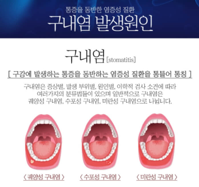 구내염 원인과 치료법 구내염에 좋은음식에 대해 알아봅시다