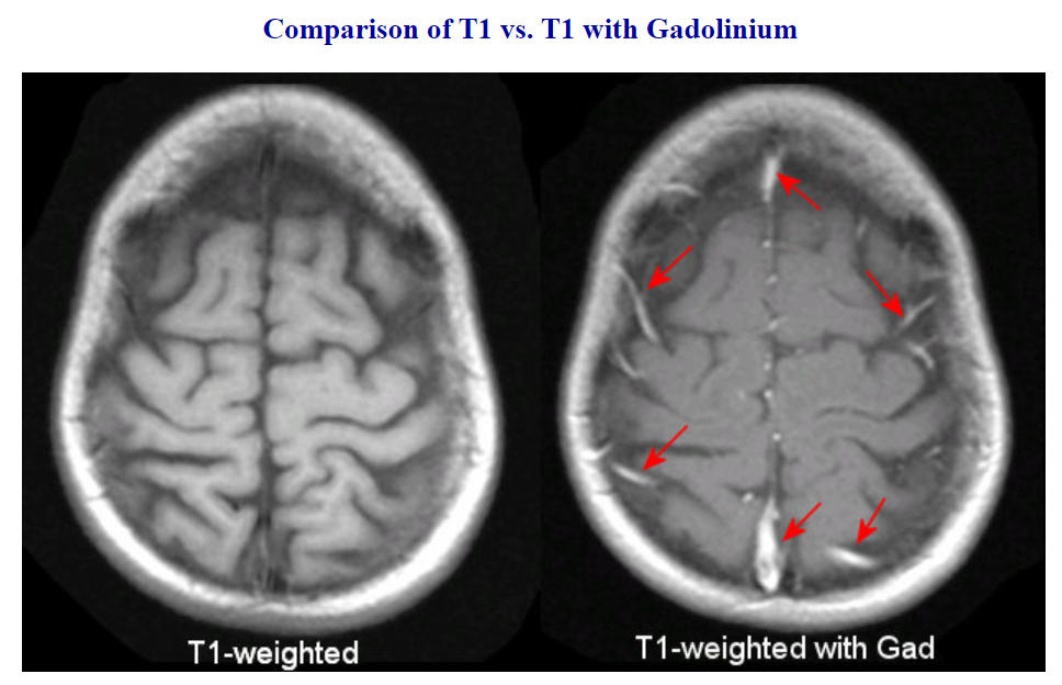 [Brain Tumor] T1W, T2W, T1Gd, Flair 영상 비교 - 용어정리 2 — scone's data