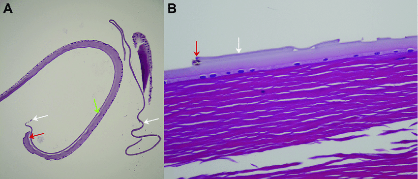 거짓비늘증후군(Pseudoexfoliation syndrome, PEX, PXS)의 원인, 유전자, 특징, 진행