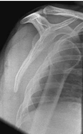 일반촬영 x-ray 엑스레이 어깨(shoulder series) - shoulder Lateral oblique (Scapula ...