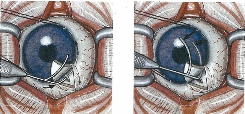 선천성 녹내장 수술, 섬유주절개술, Trabeculotomy. Suture trabeculotomy, 시술과정 방법 처치 관리