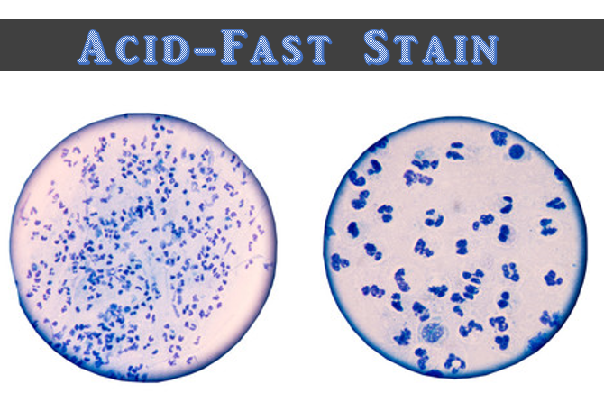 Afb염색 Afb Stain 검사 항산성균 염색 방법 결핵균 감별 Afb염색방법과 결과
