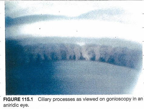 Diode Laser TransScleral CPC, 동공경유 광응고술, 눈속경유섬모체 광응고술