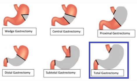 Total gastrectomy