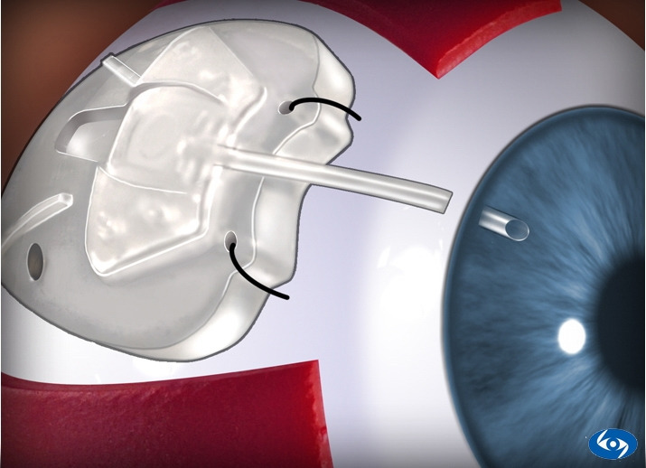 방수유출장치 Glaucoma Drainage Device / Implant, GDD, GDI 종류, Krupin, Ex ...