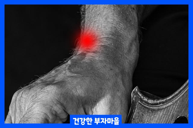 손목 건초염 원인 증상 치료 방법