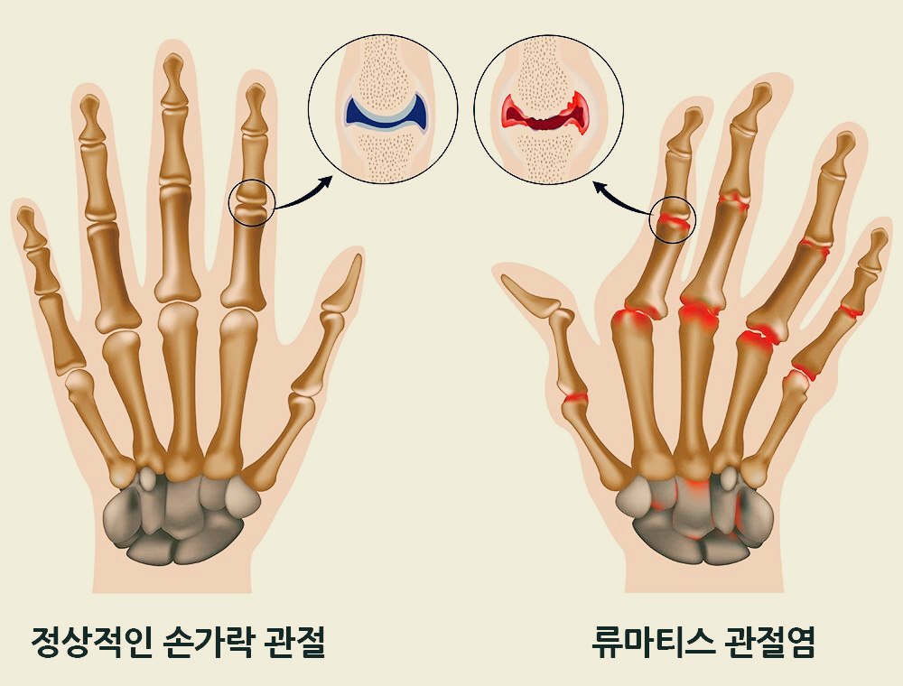 류마티스류머티즘 관절염 원인 증상 치료방법 총 정리