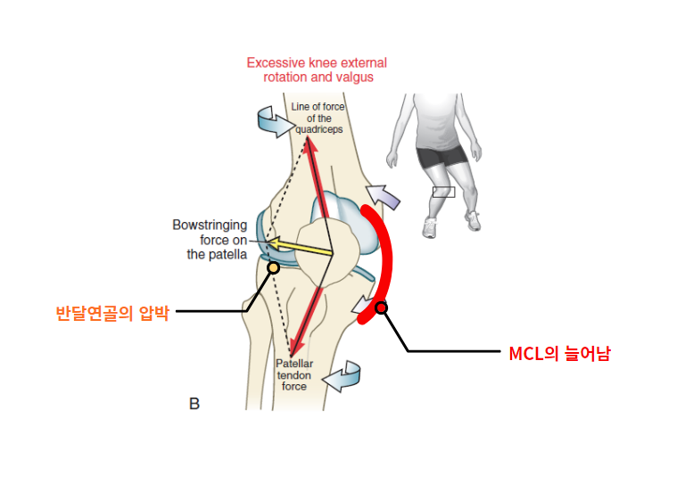 앞십자인대acl 의 손상 기전 완벽정리
