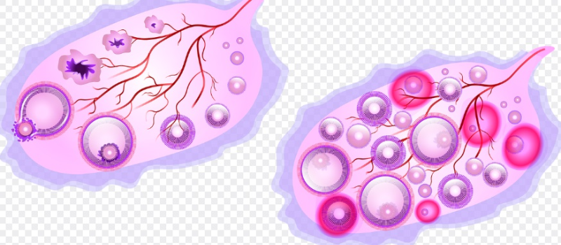 다낭성 난소 증후군pcos 원인과 증상 및 치료방법
