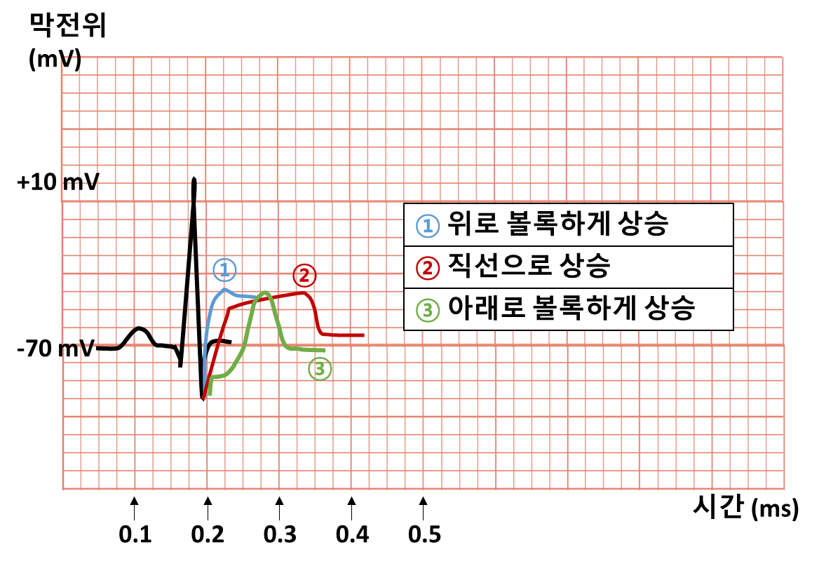 ️ ️stemi 심전도 분석 St분절 상승에 따른 심근경색
