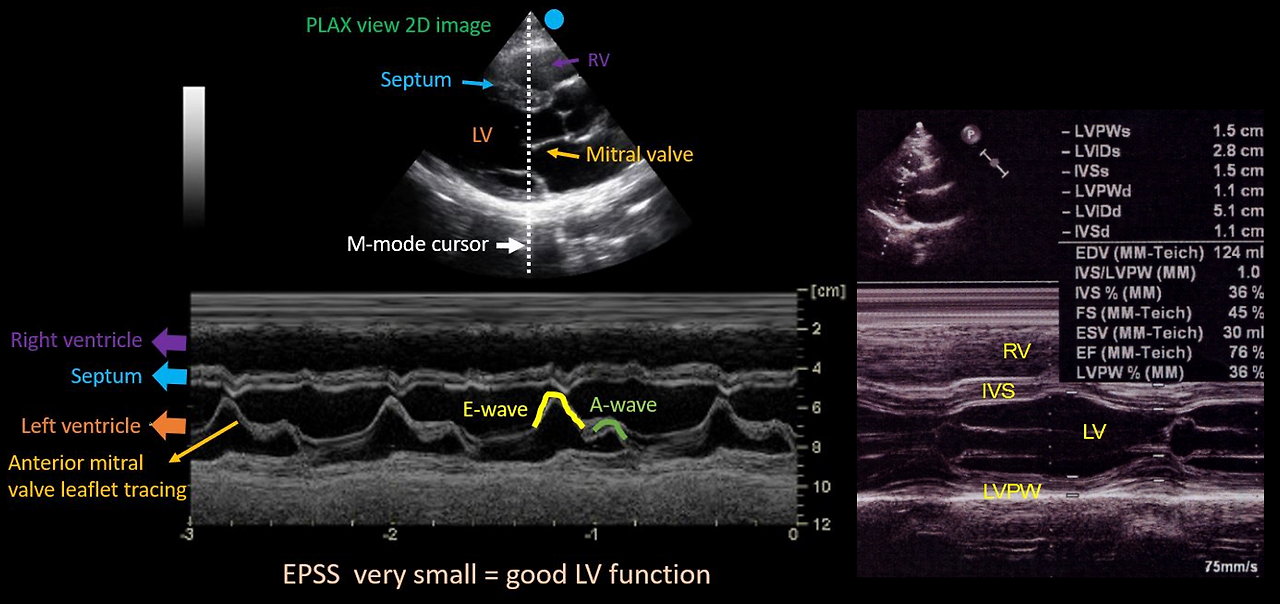[심초음파] PLAX or PSLA (parasternal long axis view)