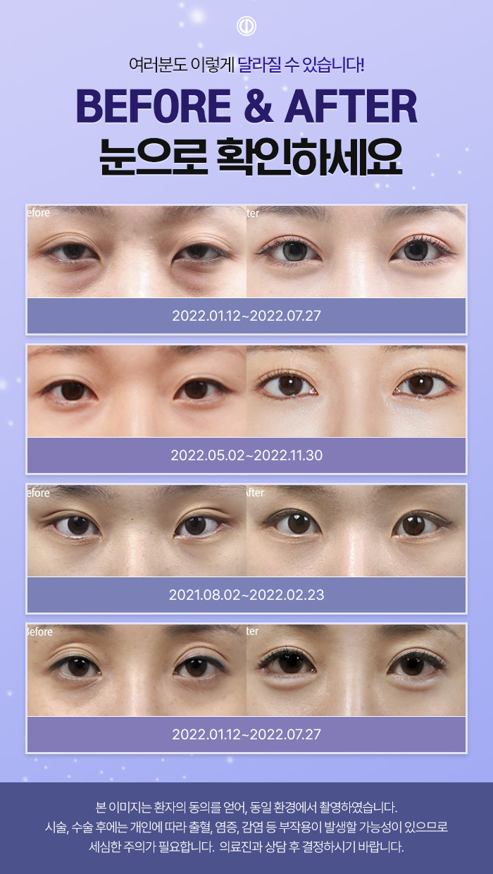 강남성형외과추천 유명한곳 재수술 잘하는곳 찾는다면은