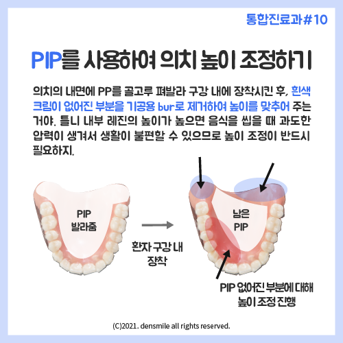[통합진료과_10] 의치(denture)의 재부착 및 높이조정 (PIP, Oneseal, COE-comfort 사용용도)