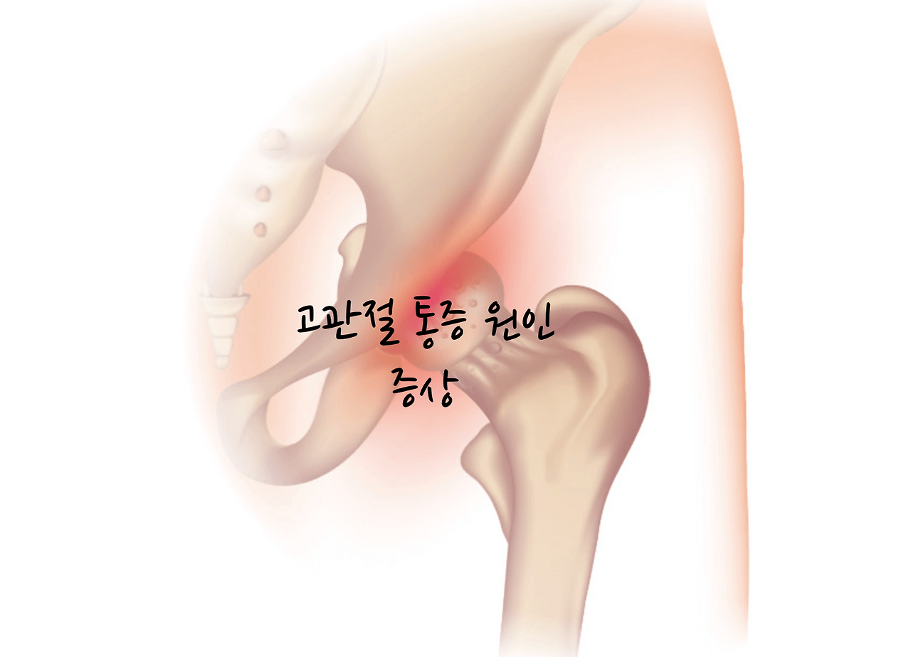 고관절 통증 원인 증상